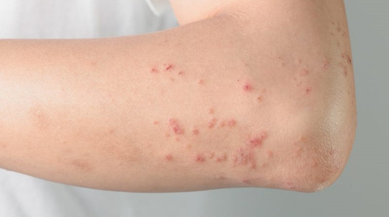 Odos bėrimai. Ką reikėtų žinoti? – Eubos Lietuva